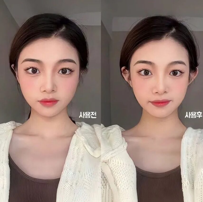 "Ear Filler" Is The Latest Plastic Surgery Trend - But Netizens Are ...