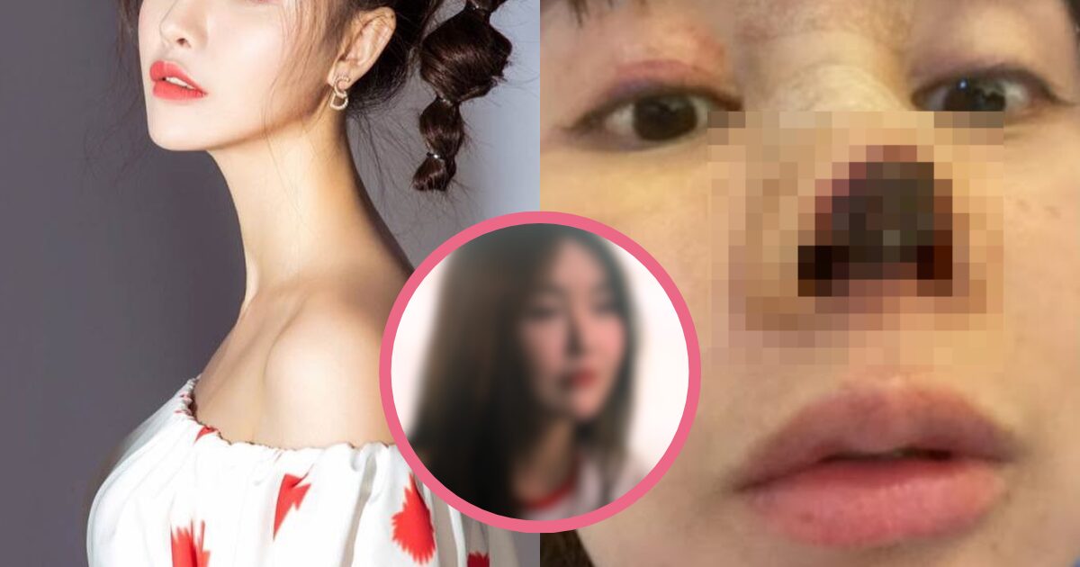 Actress's Nightmare Plastic Surgery Nearly Made Her Nose Fall Off — Where Is She Now? - Koreaboo