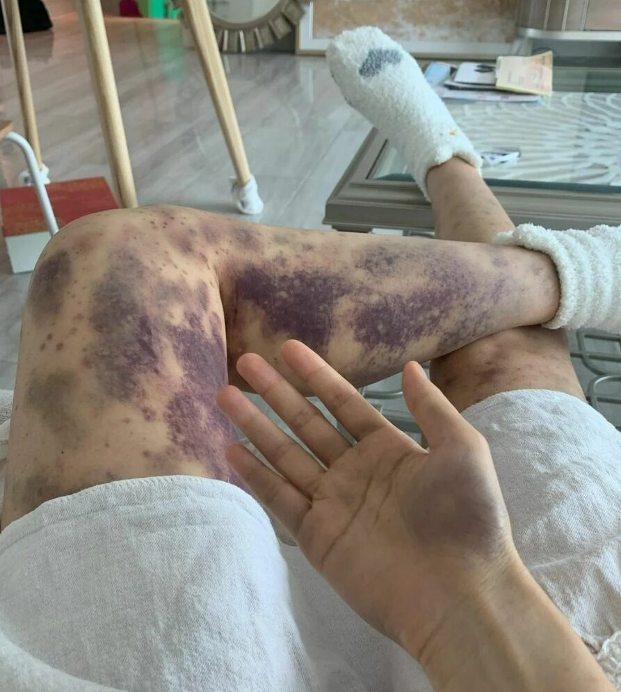 Model-Turned-Influencer Faces Alarming Aftermath Of Botched Procedure ...