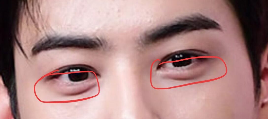 Cha Eunwoo's "Visible Plastic Surgery Scars" Go Viral Amid Tax Evasion ...